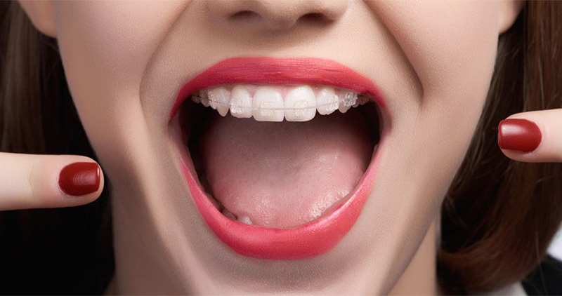 Brackets de zafiro - Beneficios, precio y duración del tratamiento